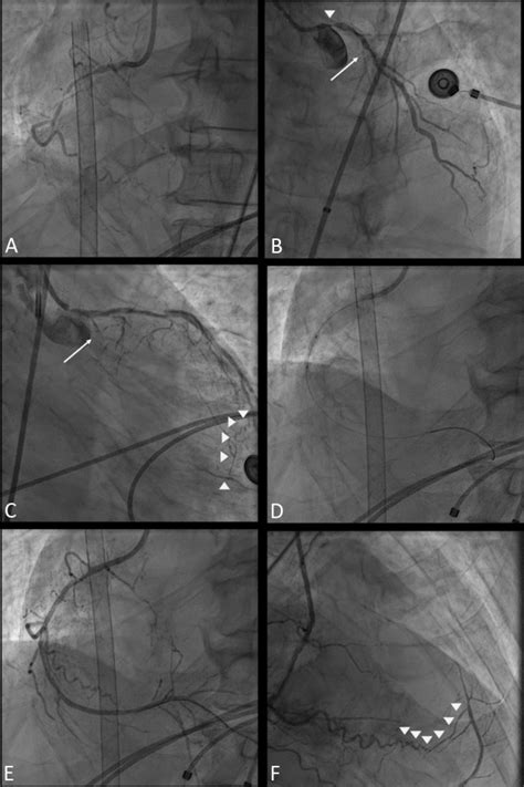 An Ideal Vascular Access In A Patient With Acute Coronary Syndrome And