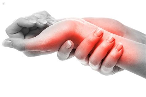 Tendinitis De Mano Qu Es S Ntomas Y Tratamiento Top Doctors