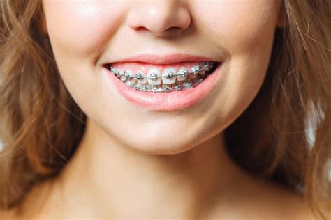 Orthodontic Treatment Dental Care Concept Beautiful Woman Healthy
