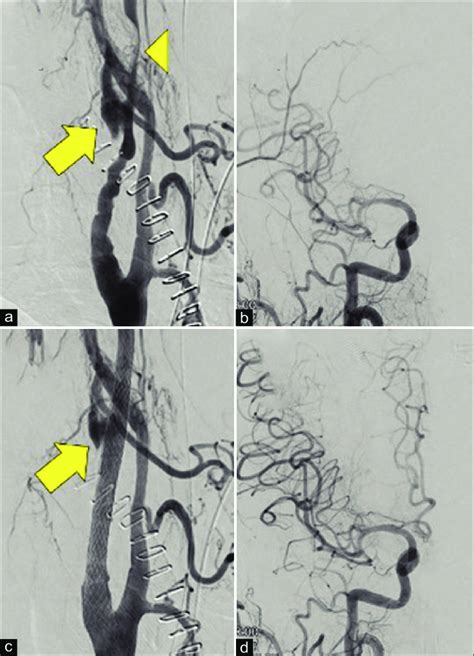 Right Common Carotid Angiography Before And After Carotid Artery