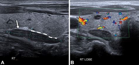 Contemporary Multimodality Imaging Of Primary Hyperparathyroidism