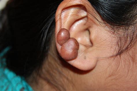 C Mo Curar Un Queloide En El Piercing Belleza Est Tica