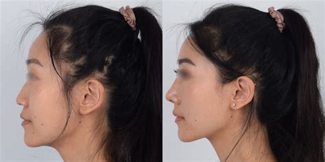 Asian Nose Job Before And After