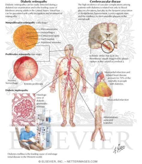 Diabetes Mellitus And Its Complications Micro And Macrovascular