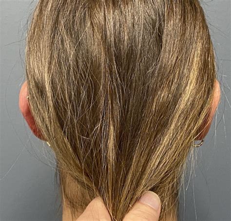 Plastic Surgery Case Study Long Term Suture Extrusion In Setback