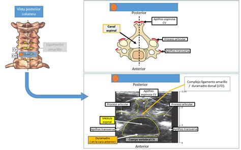 Ecograf A De La Columna Vertebral Cervical Dolopedia