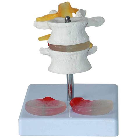 Buy Study Model 11 Human Spine Lumbar Vertebrae Lumbar Disc