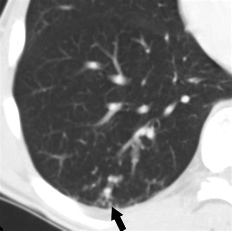 CT Angiography Of Pulmonary Embolism Diagnostic Criteria And Causes Of