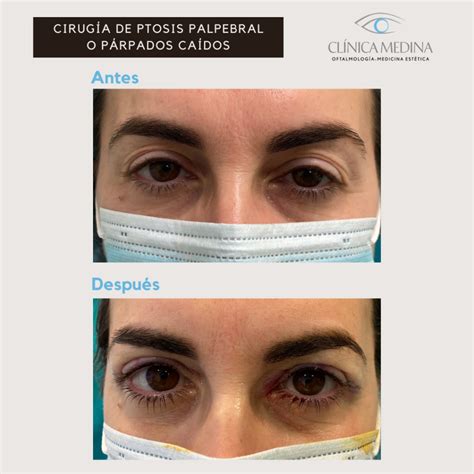 Ptosis Palpebral Causas S Ntomas Y Tratamiento Cl Nica Medina