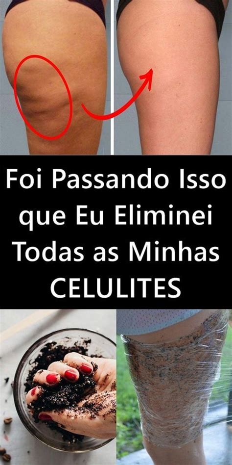 Foi Passando Isso Que Eu Eliminei Todas As Minhas CELULITES Em 2021