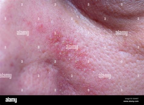 Seborrhoeic Dermatitis