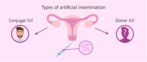 What Is Artificial Insemination With Husbands Sperm Aih