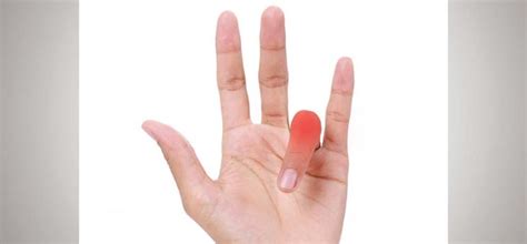 Distensiones Ligamentosas O Esguinces De Dedos Fisioterapia Talavera