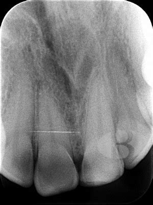 Quiste del conducto nasopalatino Clínica Dental Borrás
