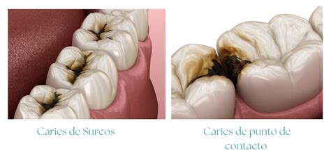 La caries dental qué es y cómo se trata González y Casado