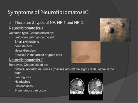 Neurofibromatosis Treatment Symptoms Causes