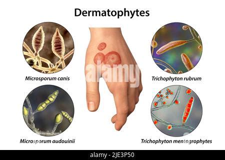 Trichophyton Rubrum Fungi Artwork Stock Photo Alamy