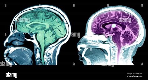 Irm Anormal Du Cerveau Banque De Photographies Et Dimages Haute