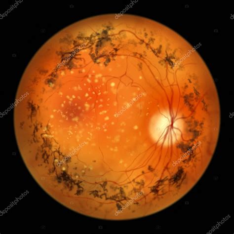 Retinitis Pigmentosa Una Enfermedad Gen Tica Ocular Una Ilustraci N