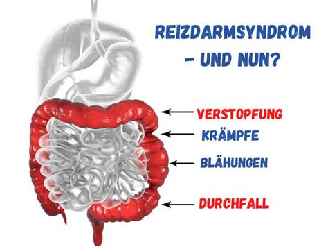 Diagramm Zum Reizdarmsyndrom