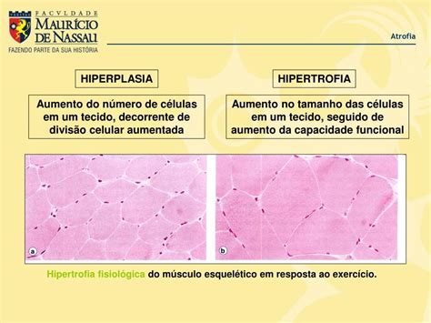 Explique A Diferença Entre Atrofia E Hipertrofia ICTEDU