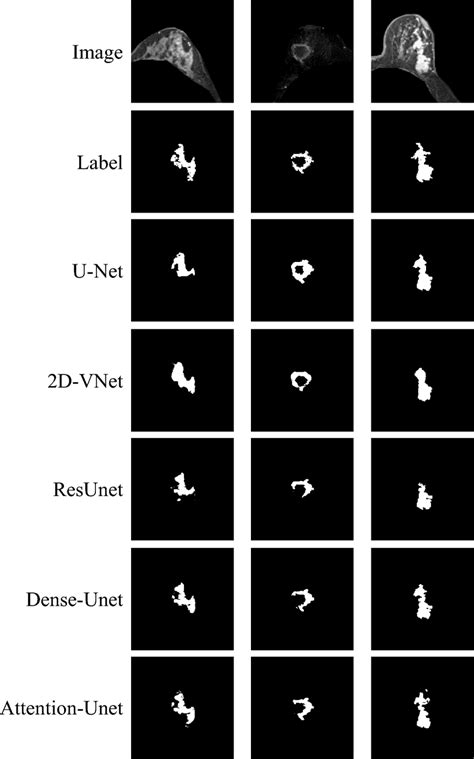partial segmentation of breast tumor lesions using the u net 2d vnet download scientific