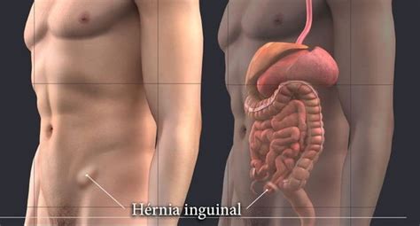 Tipos de hérnias