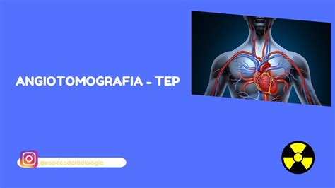 ANGIOTOMOGRAFIA Angiotomografia para diagnóstico de TEP Trombo