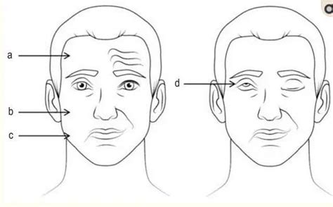 Parálisis facial tratamiento en fisioterapia JL FISIOS