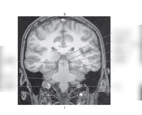 Coronal Brain Diagram Quizlet