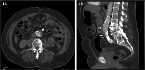 Computed Tomography Angiography CTA Performed 6 Months After
