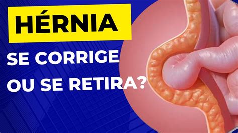 Como é a CIRURGIA DE HÉRNIA A hérnia é retirada YouTube