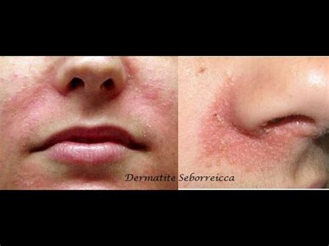 O que é Dermatite seborreica cuidados e tratamentos YouTube