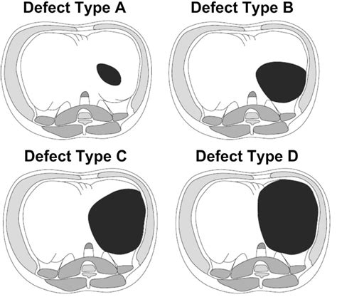 Congenital Diaphragmatic Hernia Types
