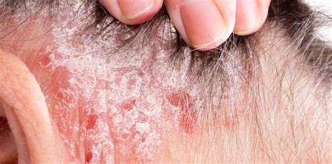 Eczema Scalp Treatment