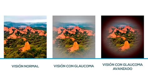 Hoy Día Mundial del Glaucoma los Institutos Oftalmológicos de