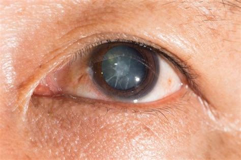 Tipos de cataratas Oftalmología Laser