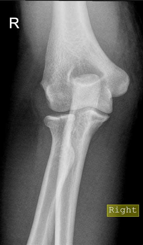 Radial Head Fracture Image Radiopaedia Org