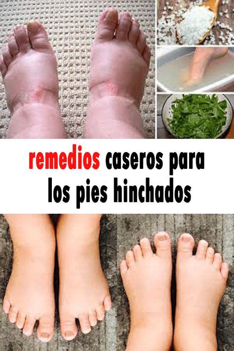Remedios Caseros Para Los Pies Hinchados Caseros Remdios Recetas
