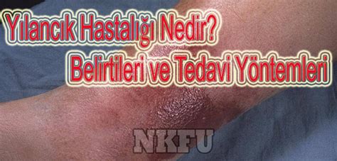 Yılancık Hastalığı Nasıl Bir Hastalıktır Belirtileri ve Tedavi Yöntemleri