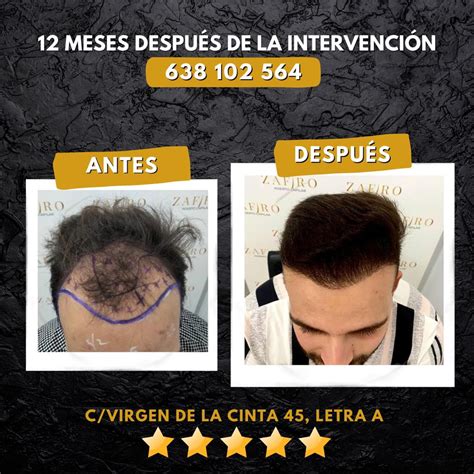 Zafiro Injerto capilar la mejor opción para tu injerto capilar en Sevilla