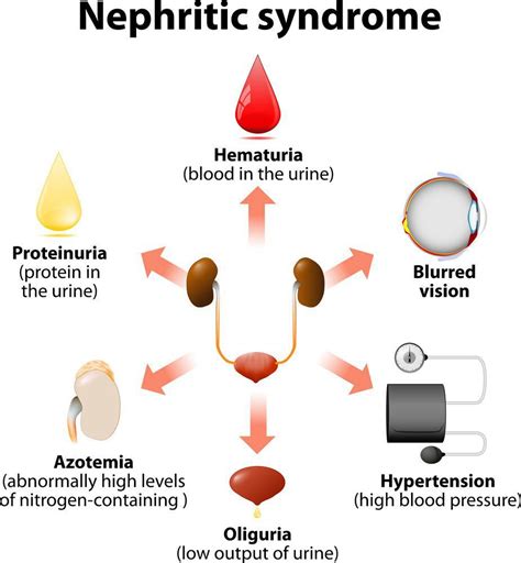 Nephritic Syndrome Medizzy