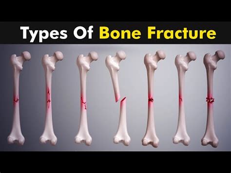 Common Types Of Bone Fracture 3D Animation