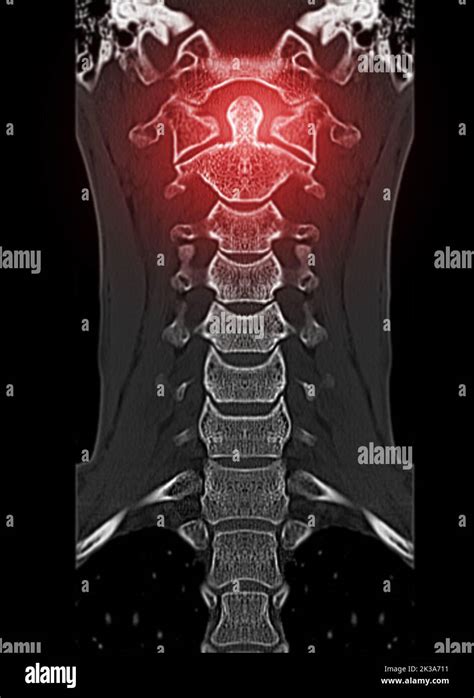 CT Scan Of C Spine Or Cervical Spine 2D Image For Diagnosis Fracture Of