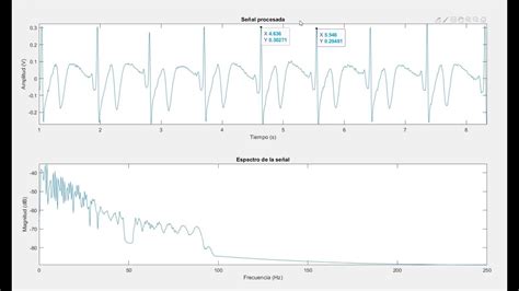 Procesamiento De Una Se Al Ecg Digital Con Matlab Para Determinar