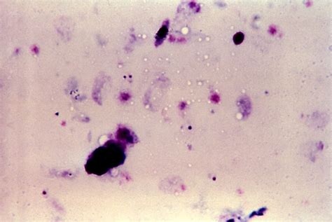 Free Picture Thick Blood Smear Photomicrograph Comma Shaped