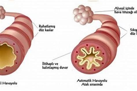 Astım Nedir Belirtileri ve Tedavisi Hastalıklar Sağlık Spor