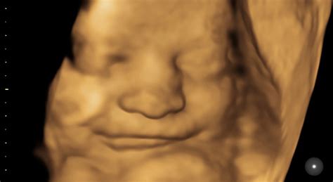 Ultrasound Direct Premium 4D Bonding Scan