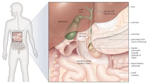 Understanding Gallstones And Gallbladder Disease