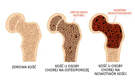 Czy Osteoporoza To Rak Ko Ci Mit W I Fakt W Na Temat Osteoporozy